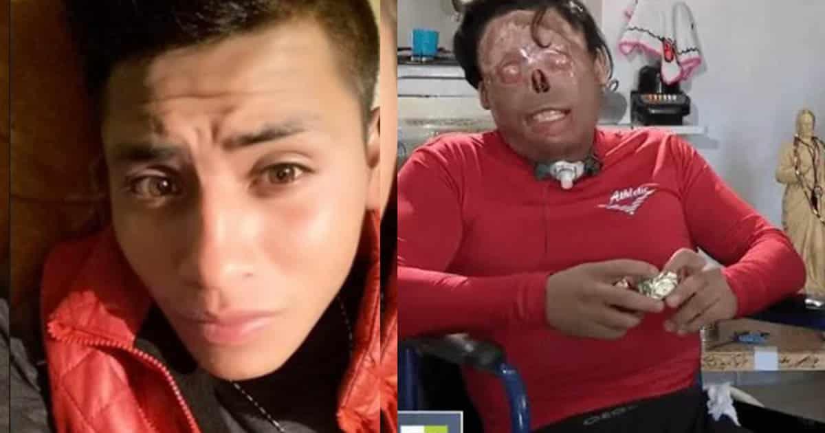 Sufre descarga que lo deja sin piernas y rostro; su familia lo abandona